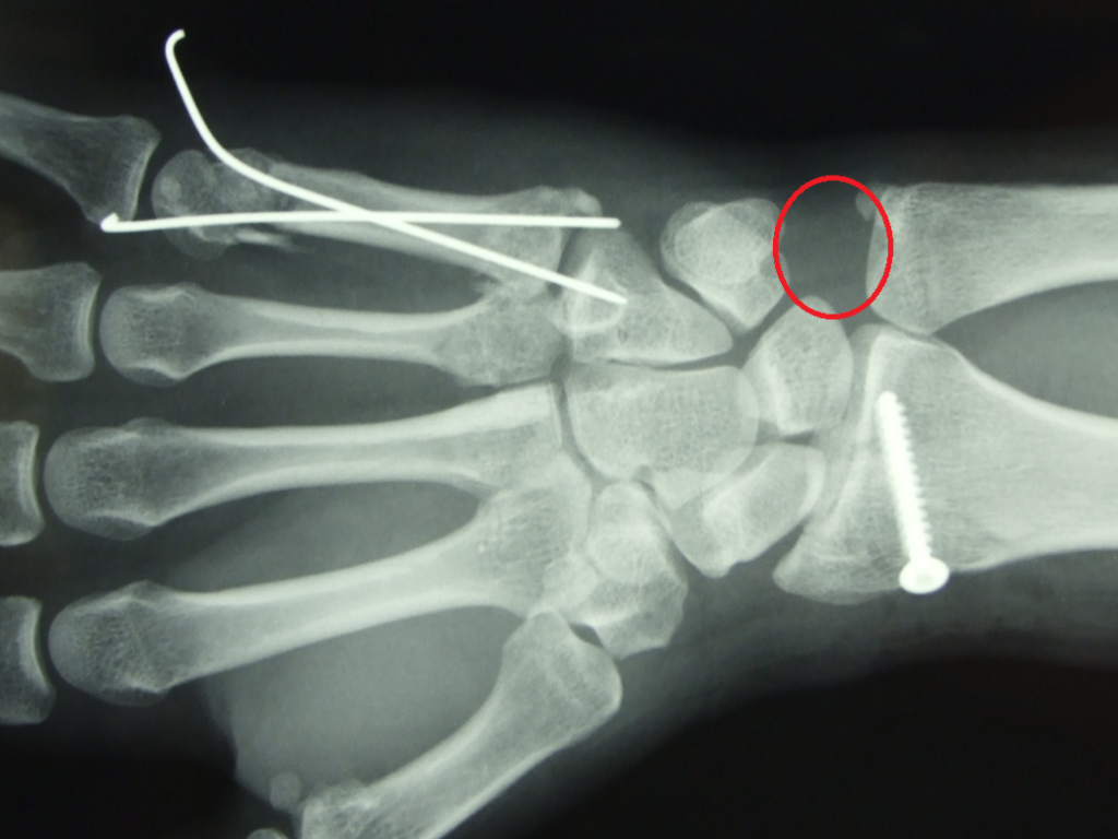 三角繊維軟骨複合体（TFCC）損傷の治療方法やテーピング - Body Problem